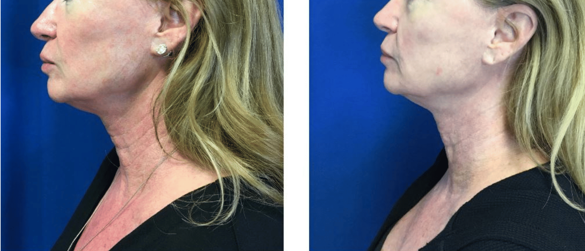 Scarlet SRF Photo Gallery | QnA Cosmetic Surgery & Medical Spa