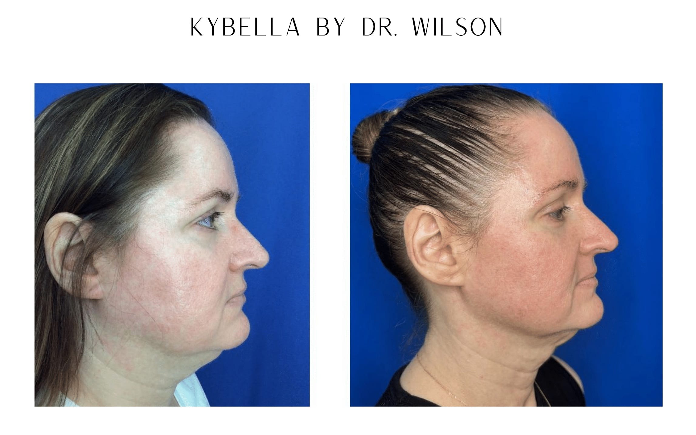 KYBELLA Neck Fat Treatment Photo Gallery | QnA Cosmetic Surgery ...